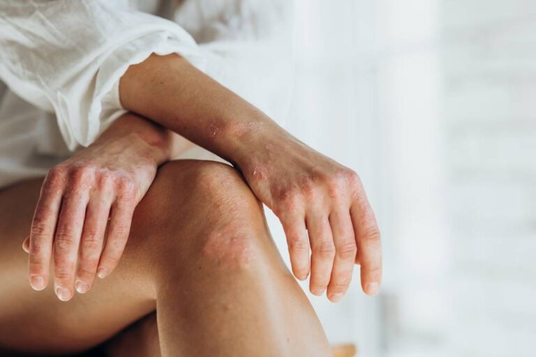 Does Arthritis Affect the Skin? Can It Cause Skin Issues?