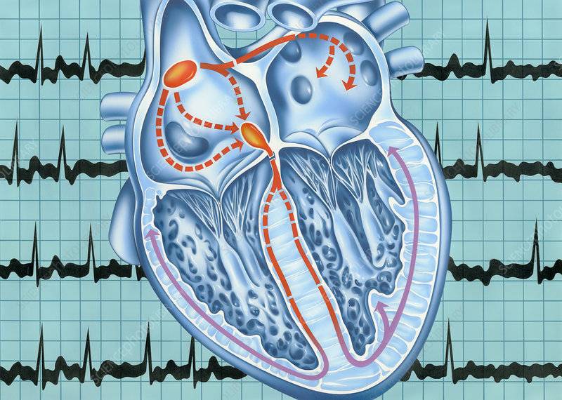 Atrial Fibrillation: Causes, Symptoms, Management and Treatment